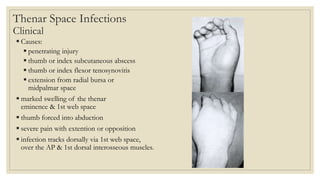 Hand infections | PPTX