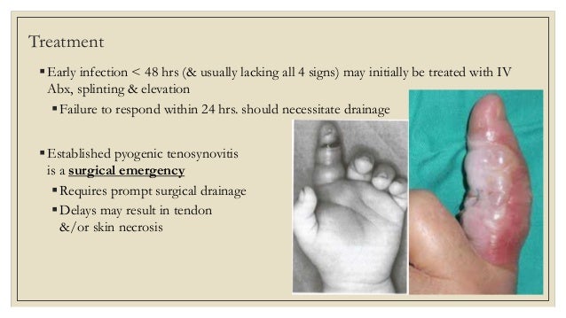 Hand infections