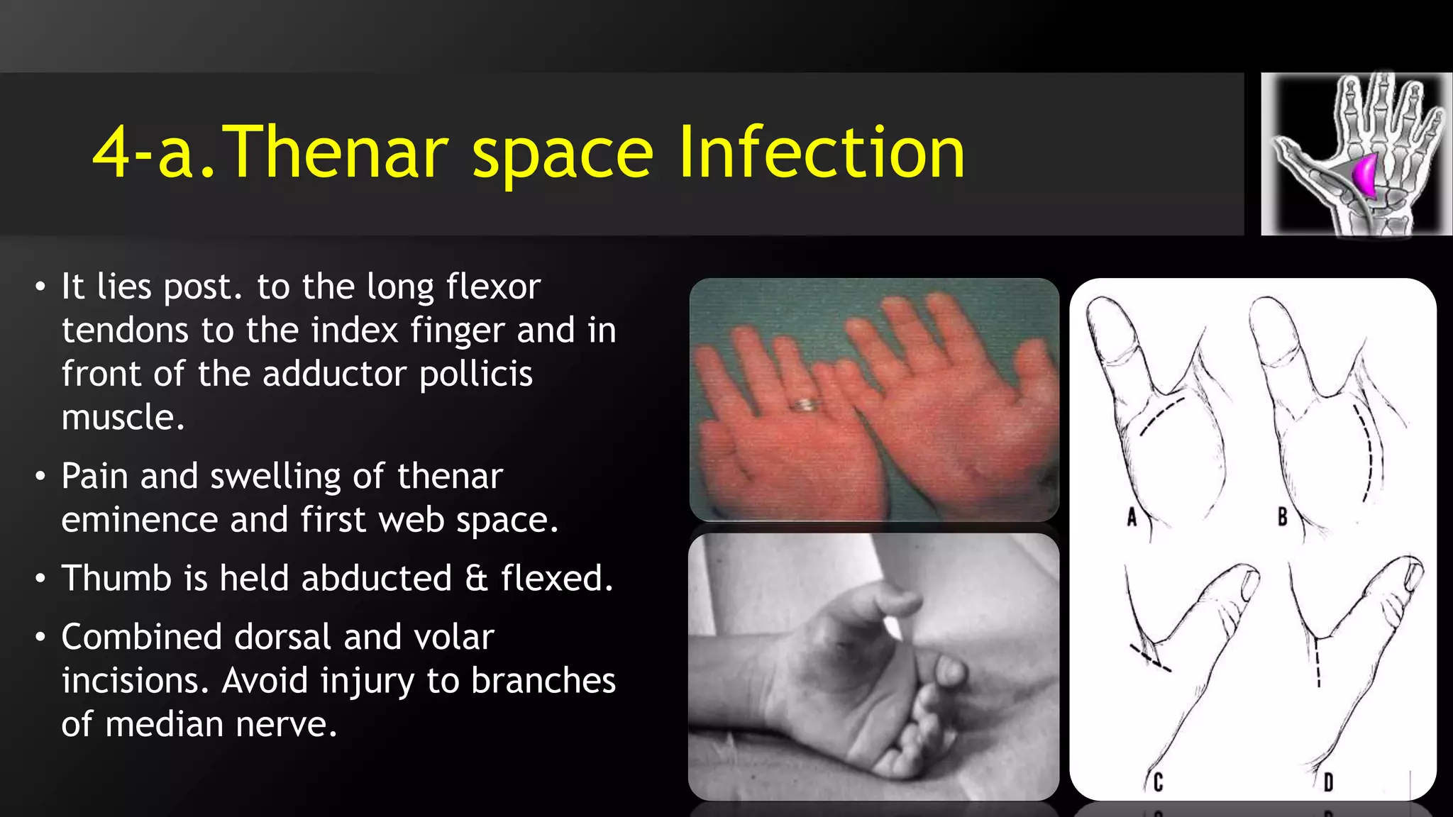 Hand & Foot infections | PPTX