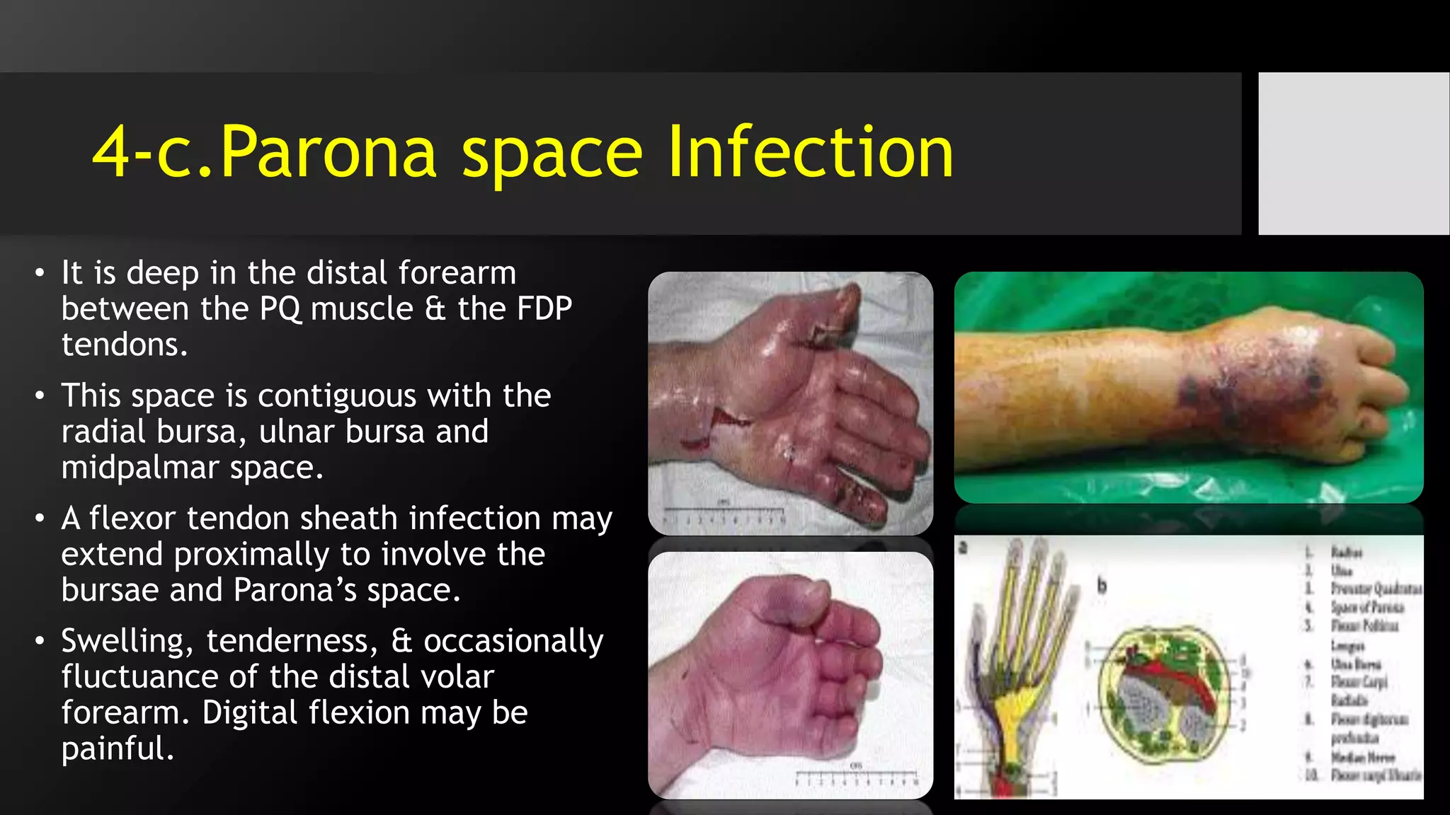 Hand & Foot infections | PPTX