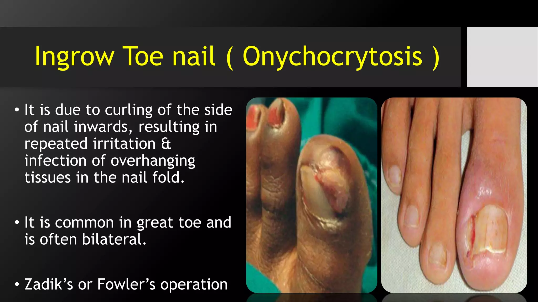 Hand & Foot infections | PPTX