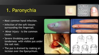 Hand & Foot infections | PPTX