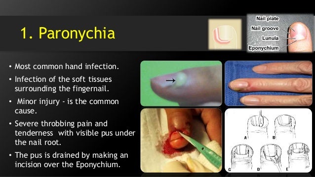 Hand & Foot infections