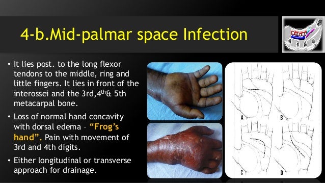Hand & Foot infections