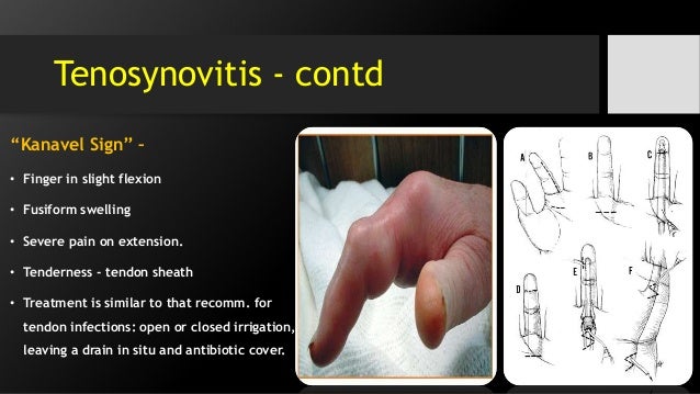Hand & Foot infections