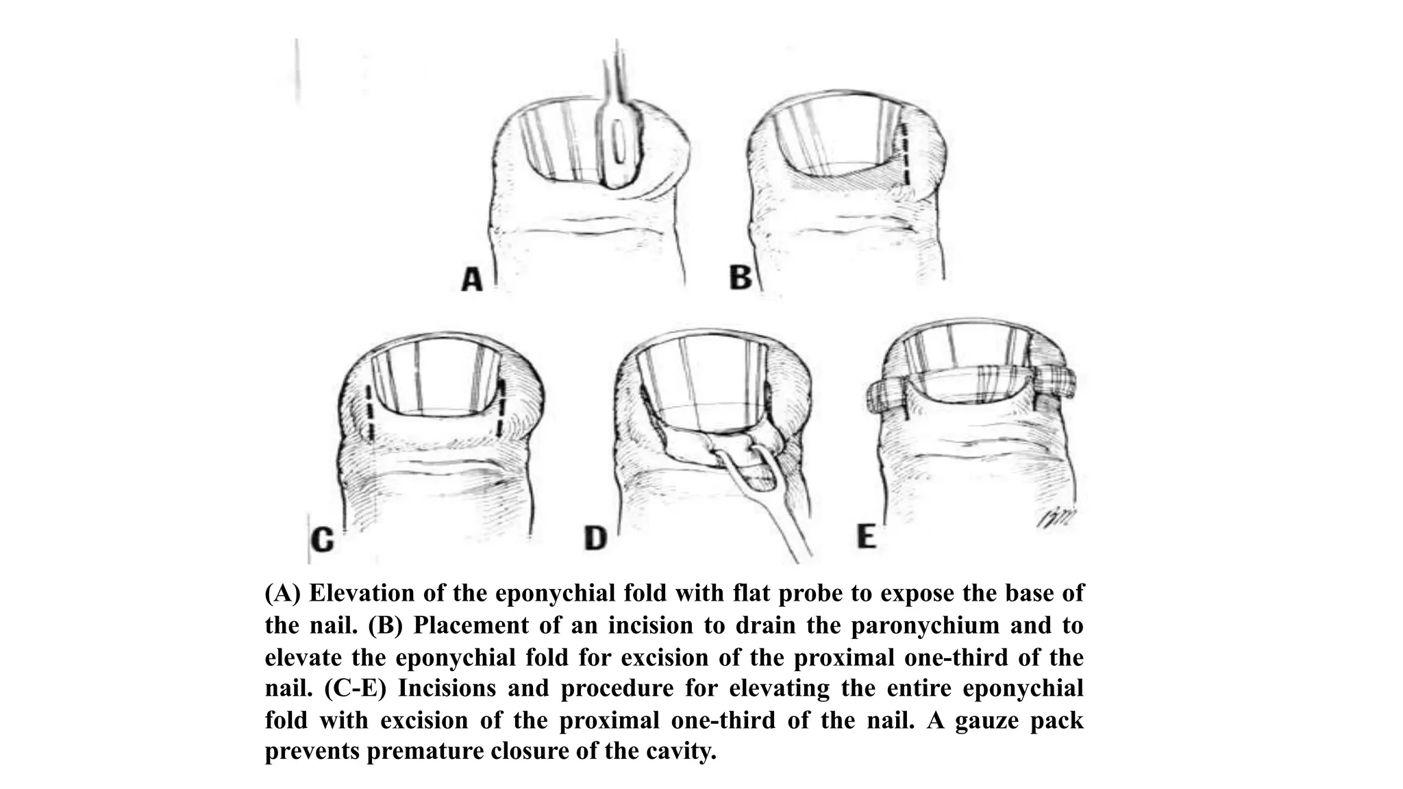 Hand infections | PDF