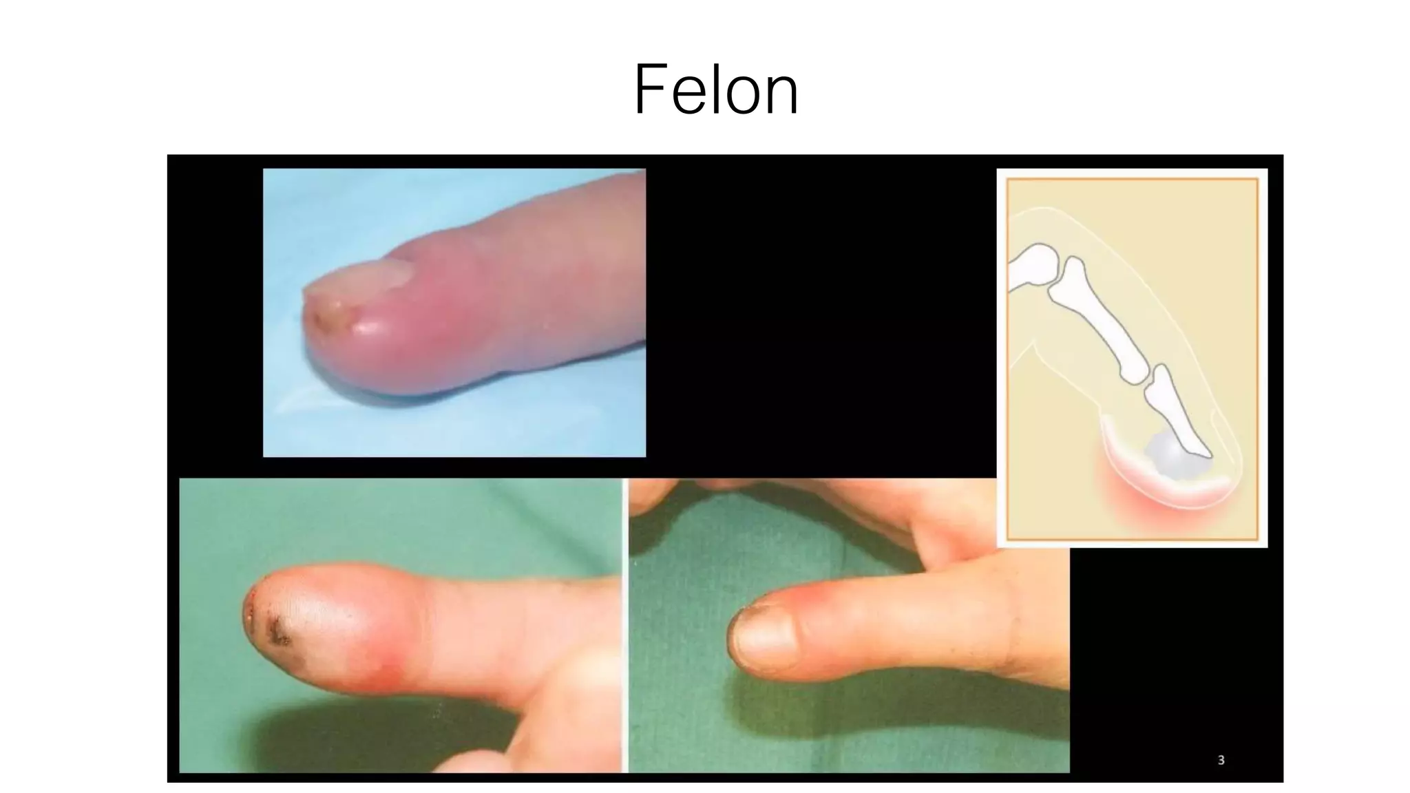 Hand infections | PDF