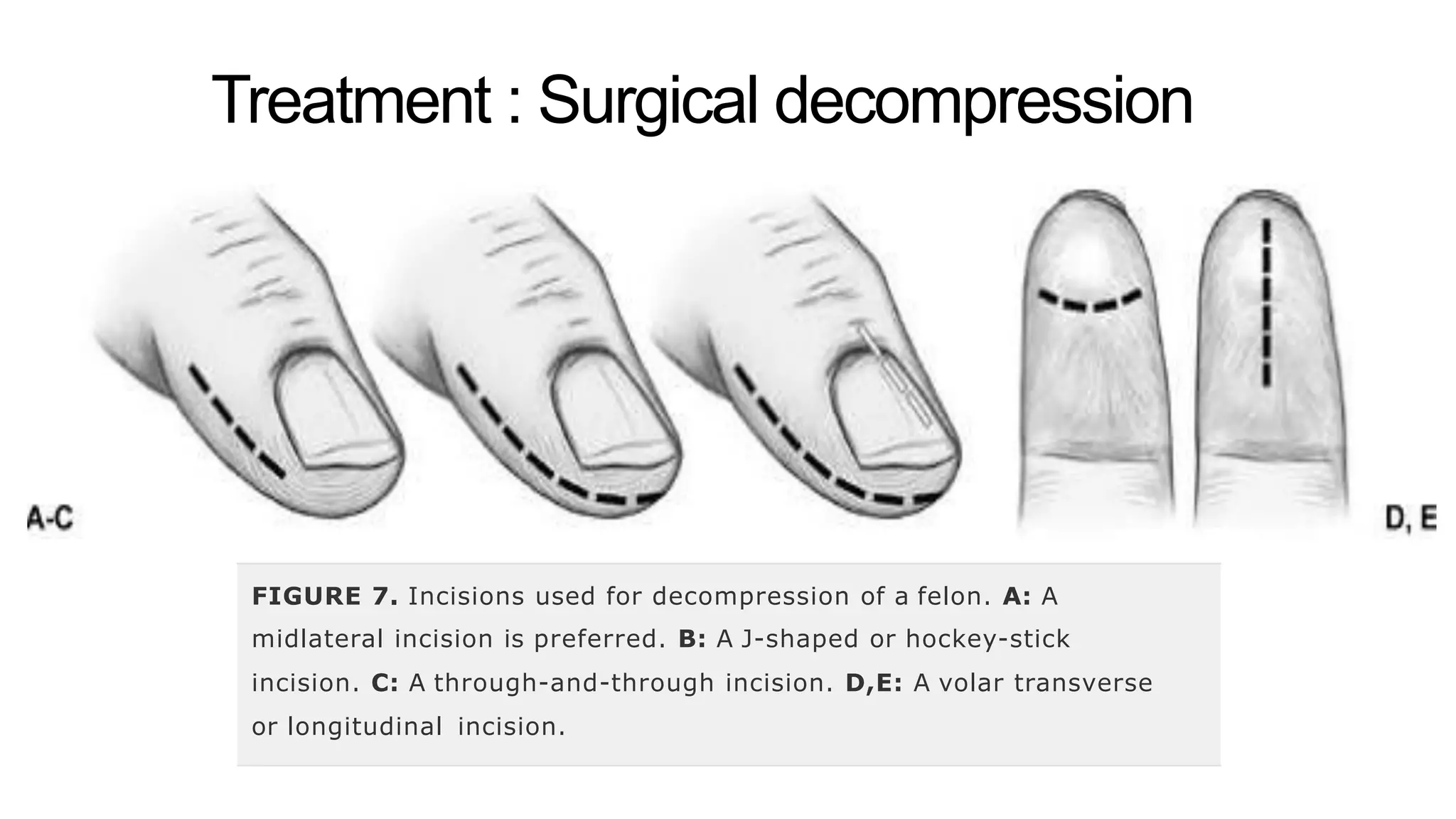 Hand infections | PDF