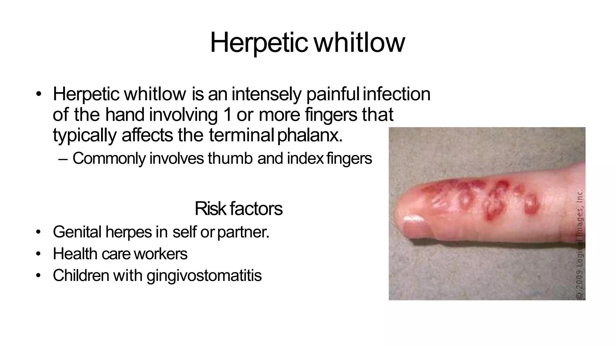 Hand infections | PDF