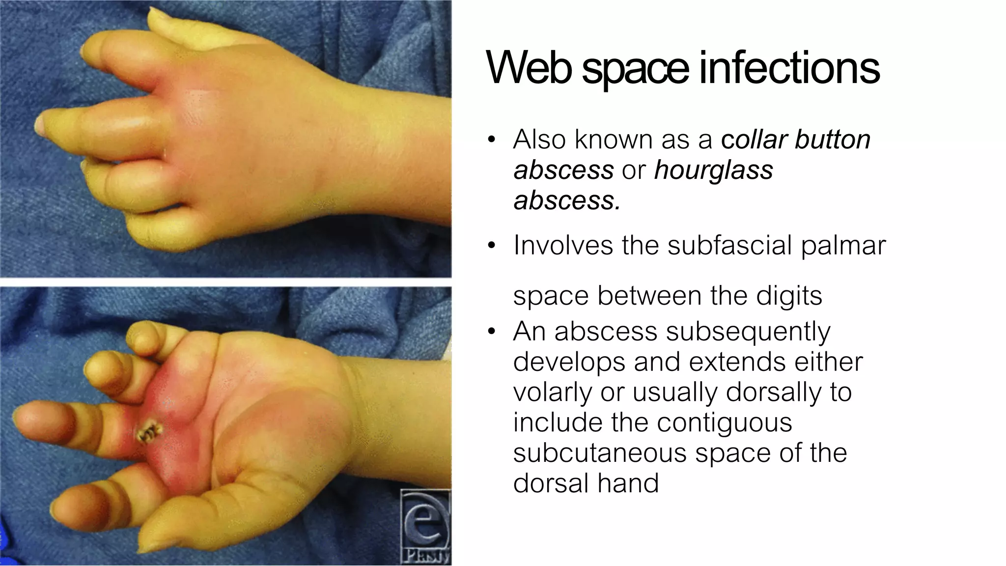 Hand infections | PDF
