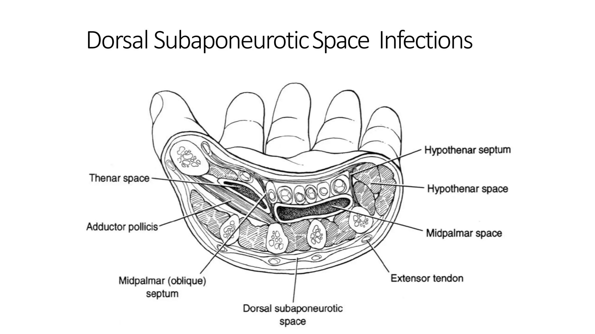 Hand infections | PDF