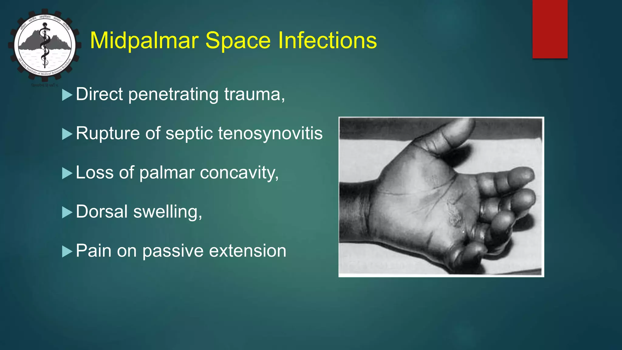 Hand infections | PPTX