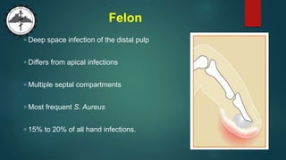 Hand infections | PPTX
