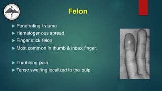 Hand infections | PPTX