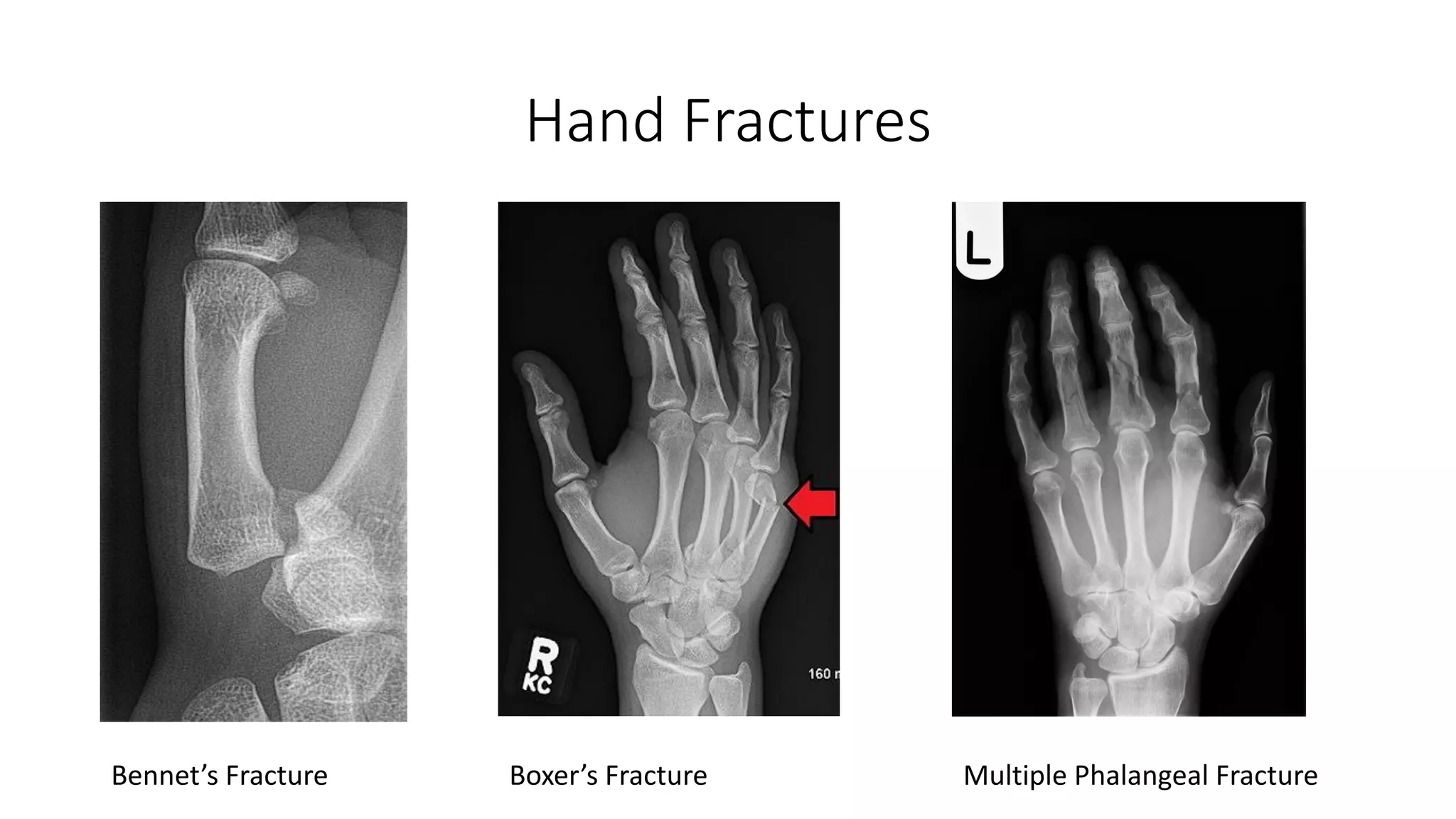 HAND INJURIES.pdf