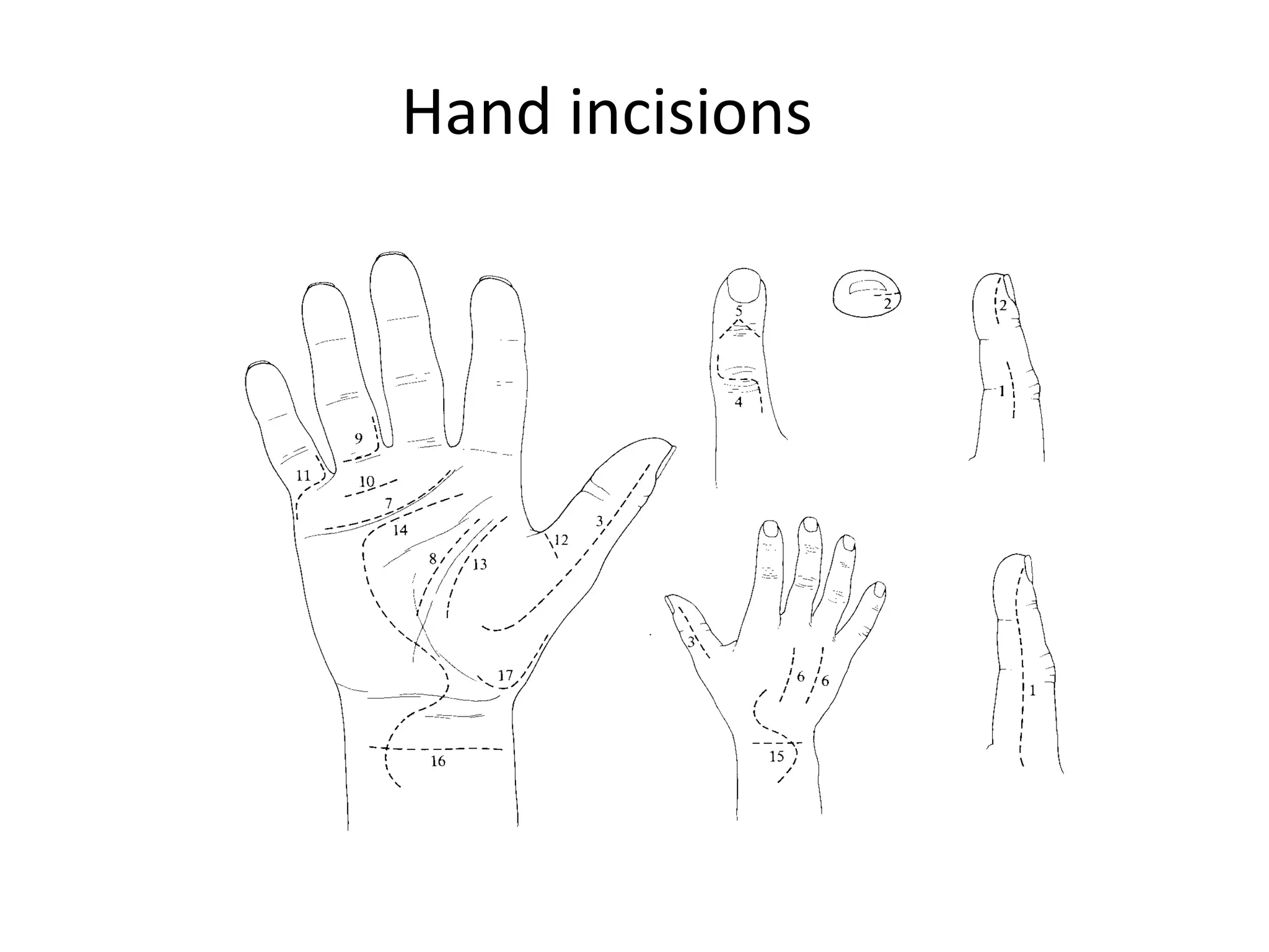 Hand Injuries Overview- Surgery | PPT