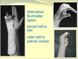 Hand injuries | PPTX
