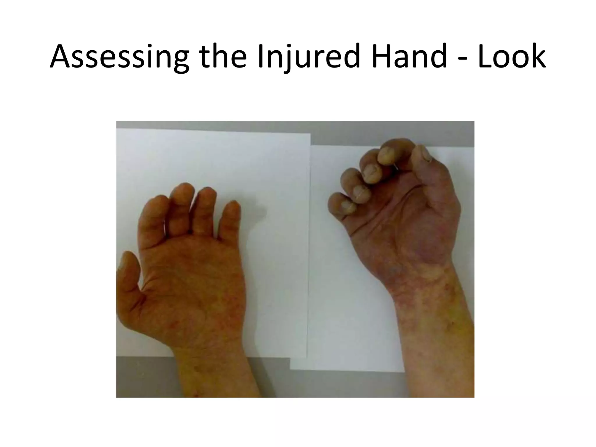 hand_injuries_PPT.ppt
