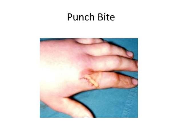 hand_injuries_PPT.ppt