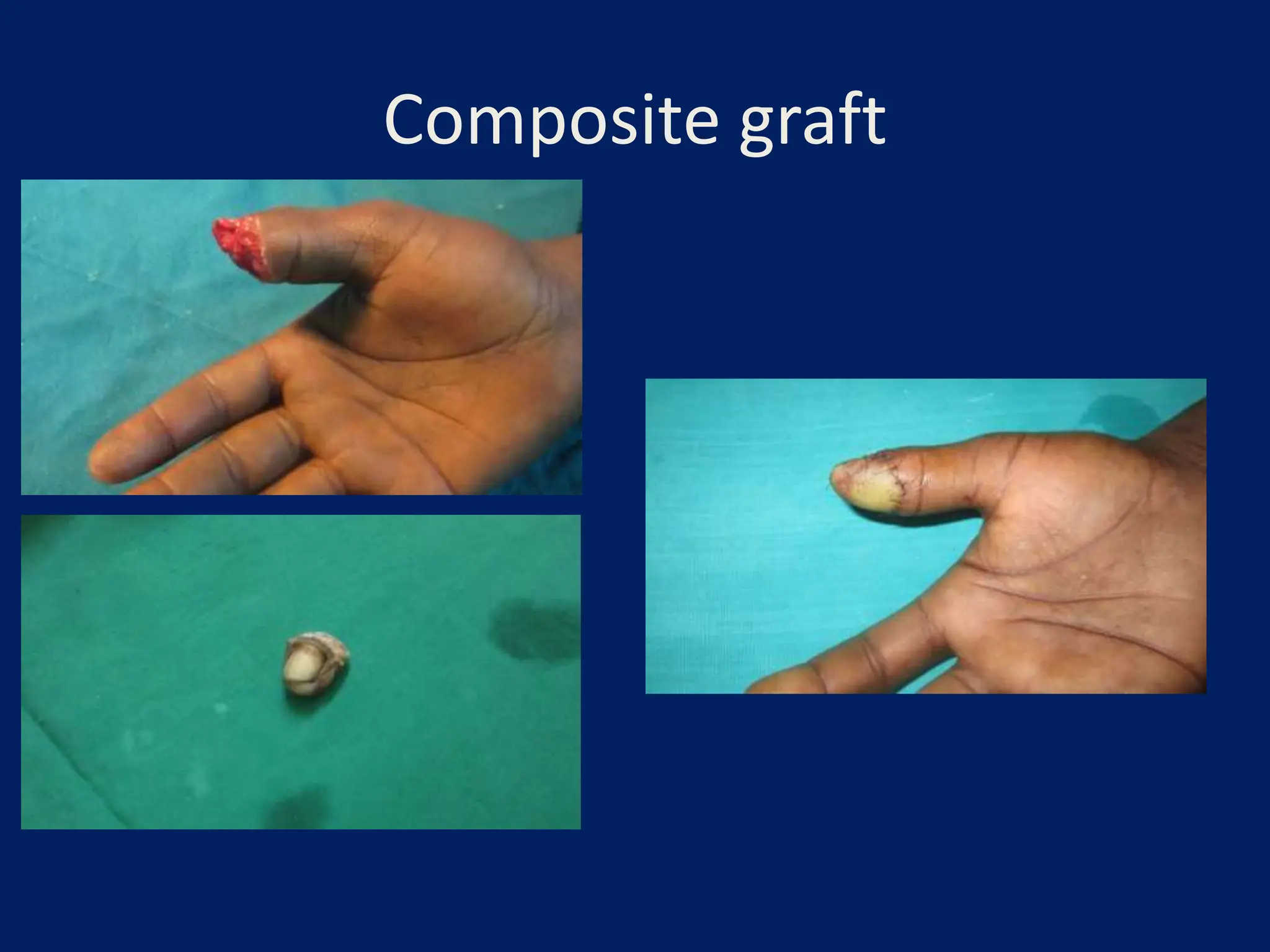 hand injury presentation to be use in safety comaign | PPT