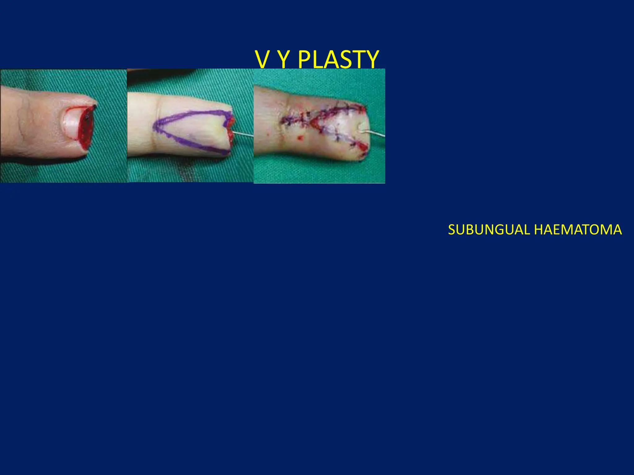 hand injury presentation to be use in safety comaign | PPT