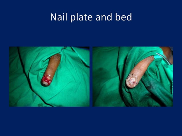 hand injury presentation to be use in safety comaign | PPT