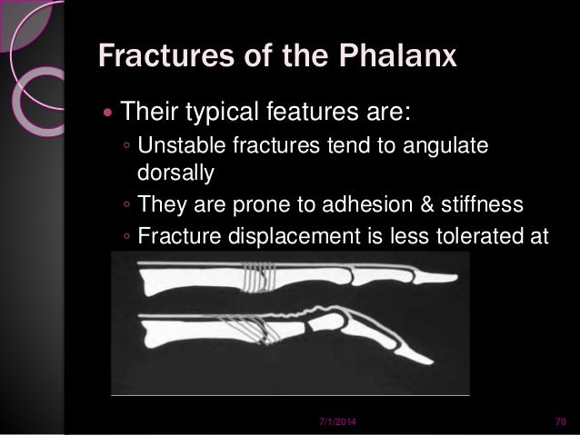 Results Of The Kapandji Procedure In The Ao Type C Distal Radius