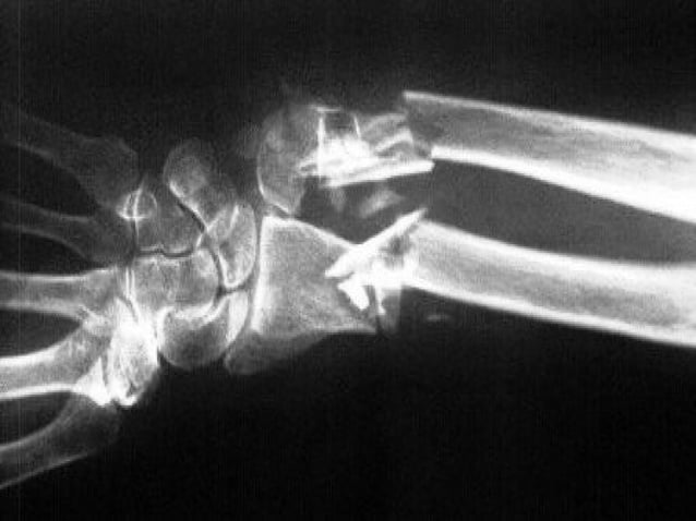 Hand Injury Prevention Campaign Watch Your Finger | PPTX | First Aid ...