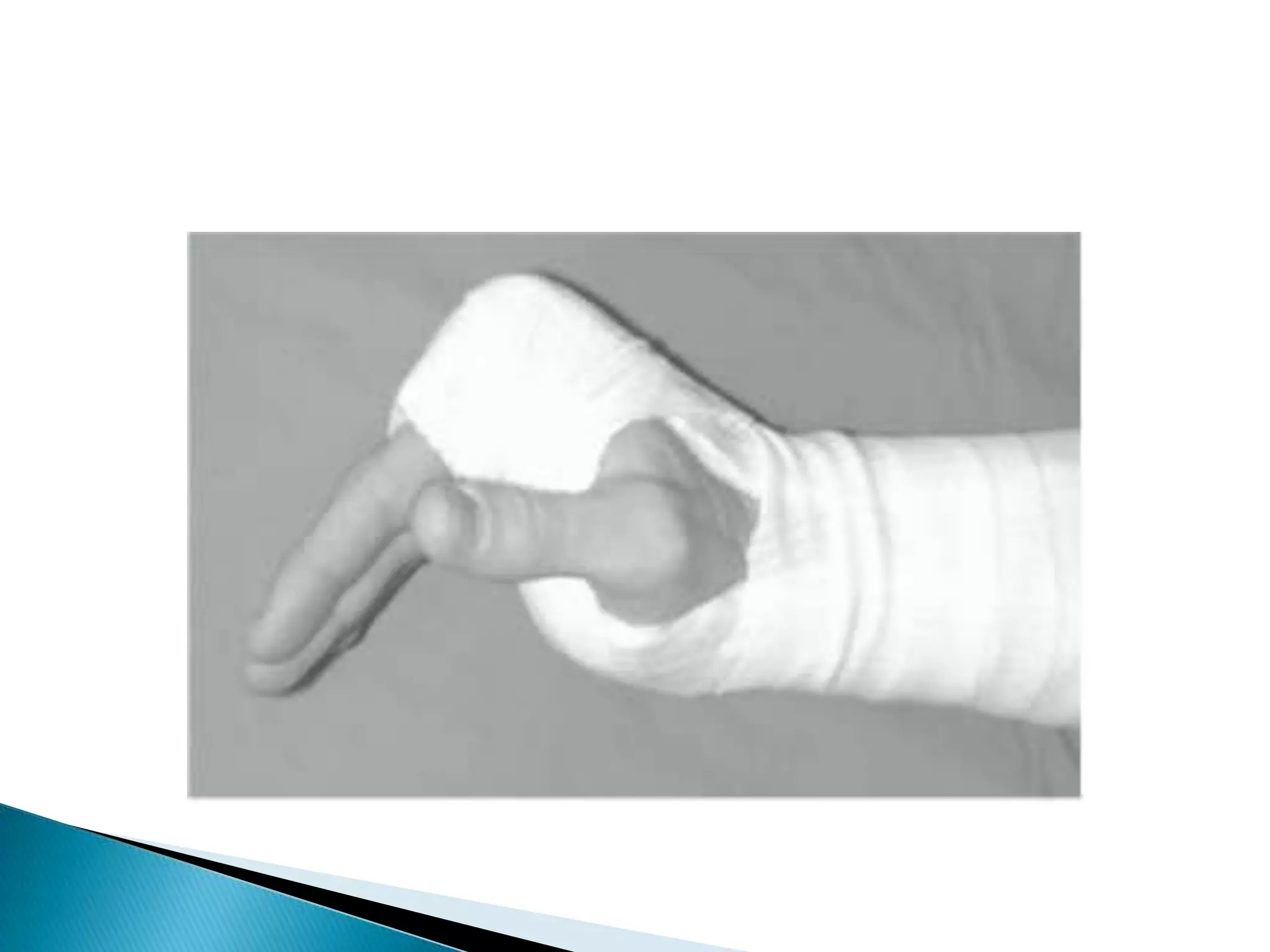Hand injury assessment | PPTX