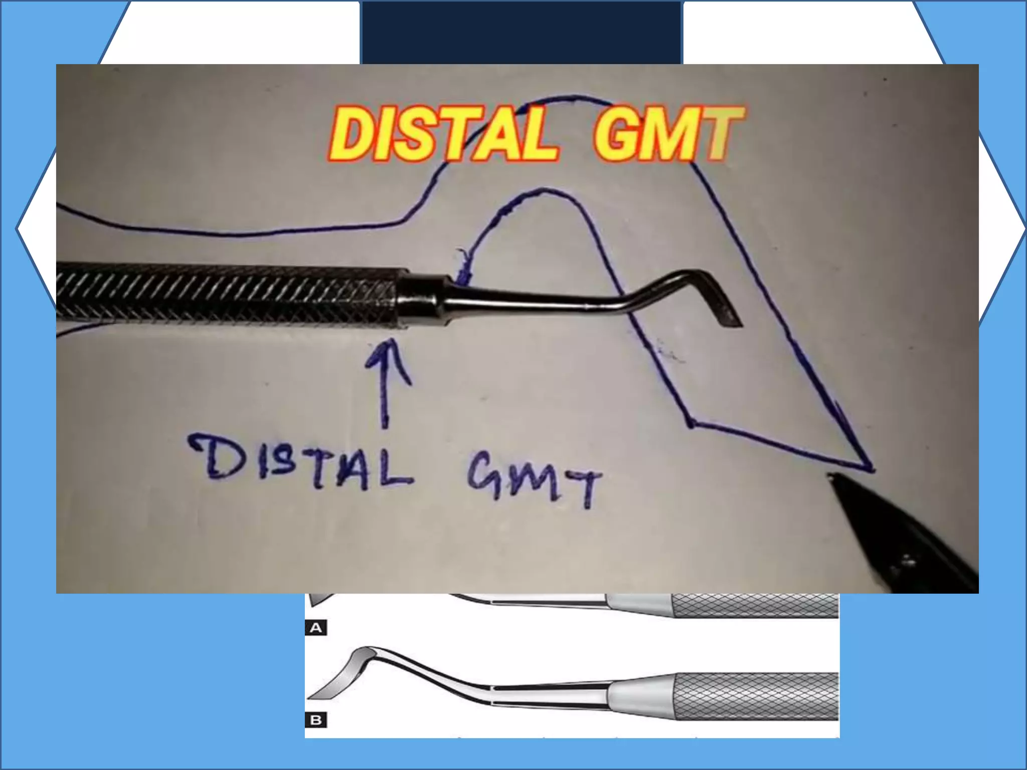 Hand instruments in operative dentistry | PPT