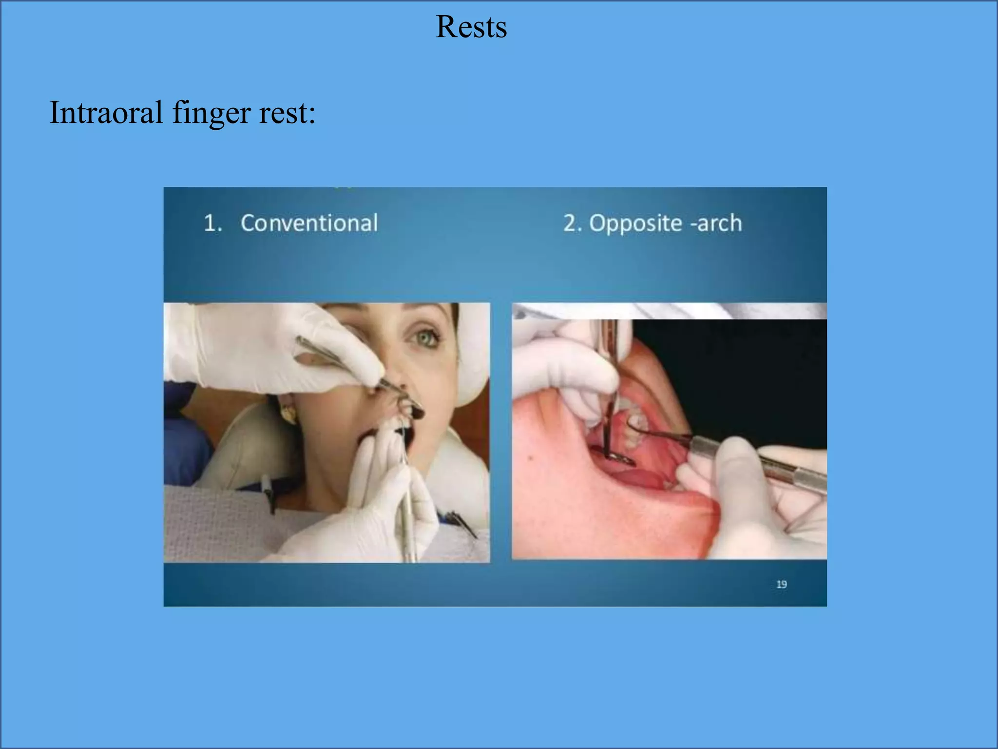 Hand instruments in operative dentistry | PPT