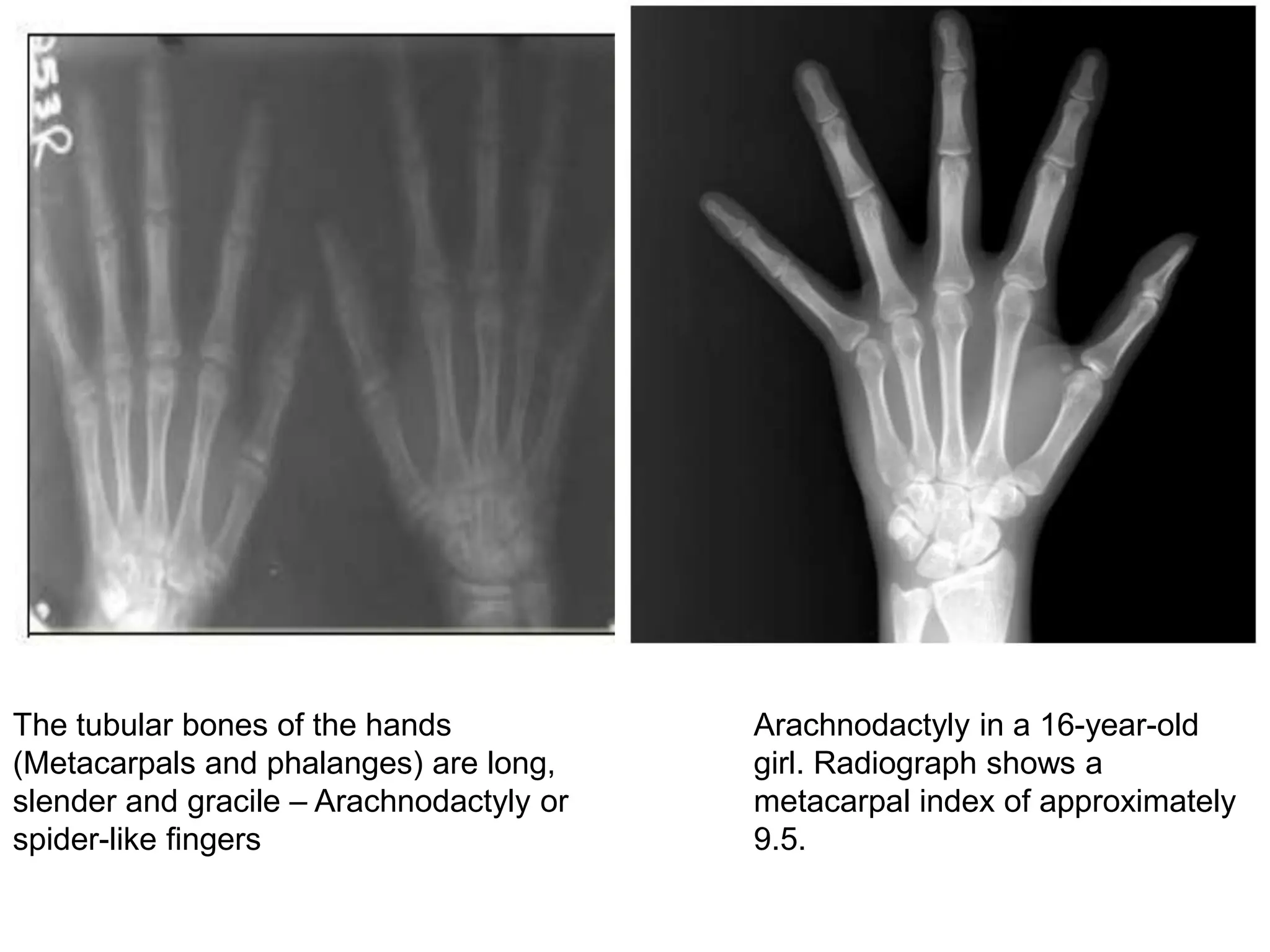 radiology of hand in systemic diseases ppt | PPTX