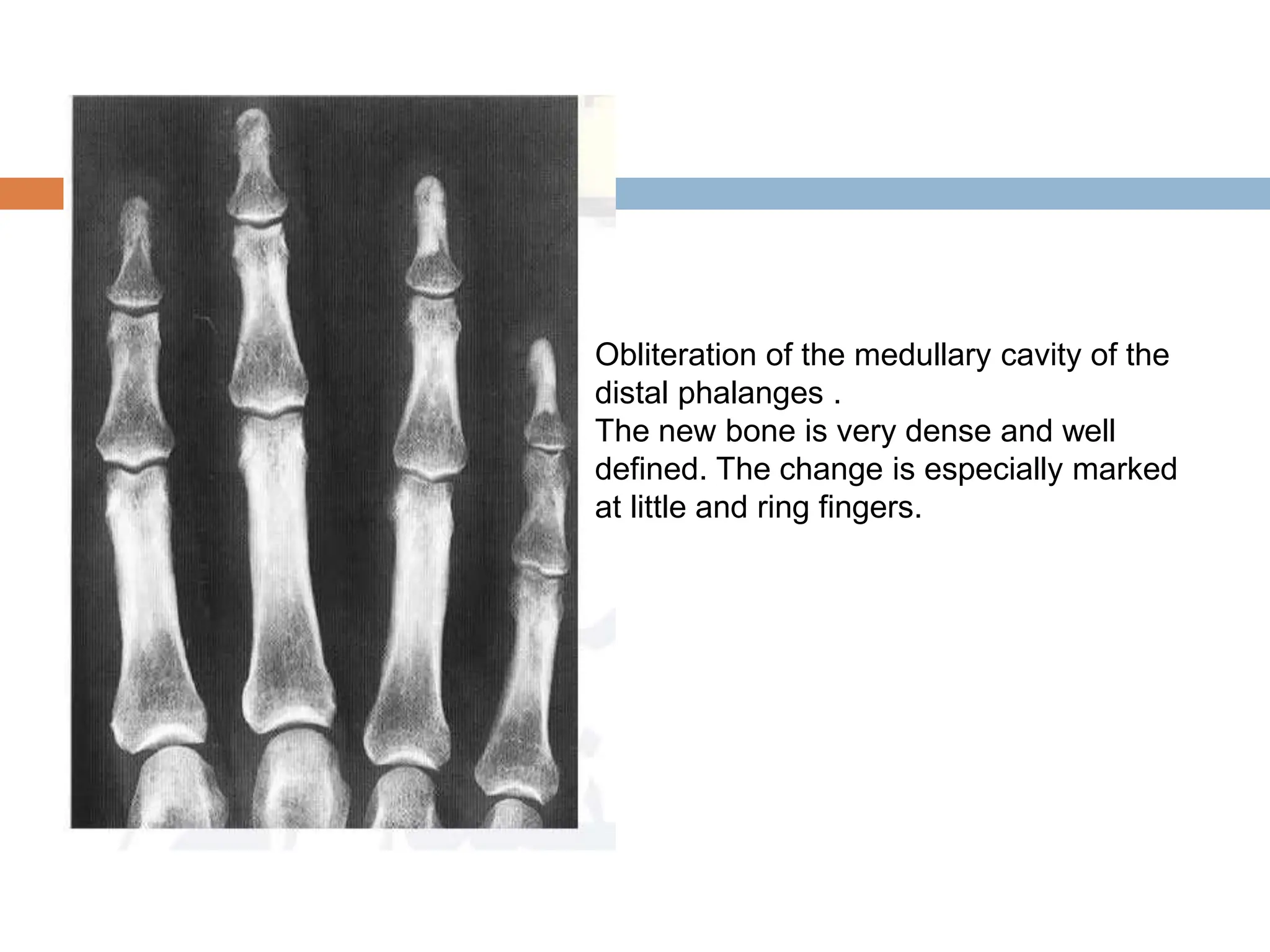 radiology of hand in systemic diseases ppt | PPTX