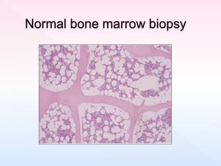 Normal Bone Marrow Biopsy