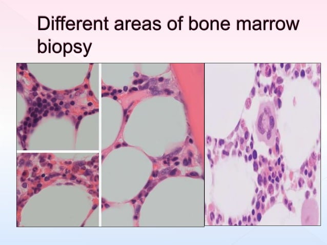 processing of bone marrow trephine biopsy | PPTX
