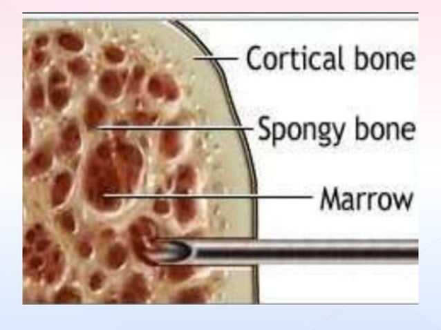 processing of bone marrow trephine biopsy | PPTX