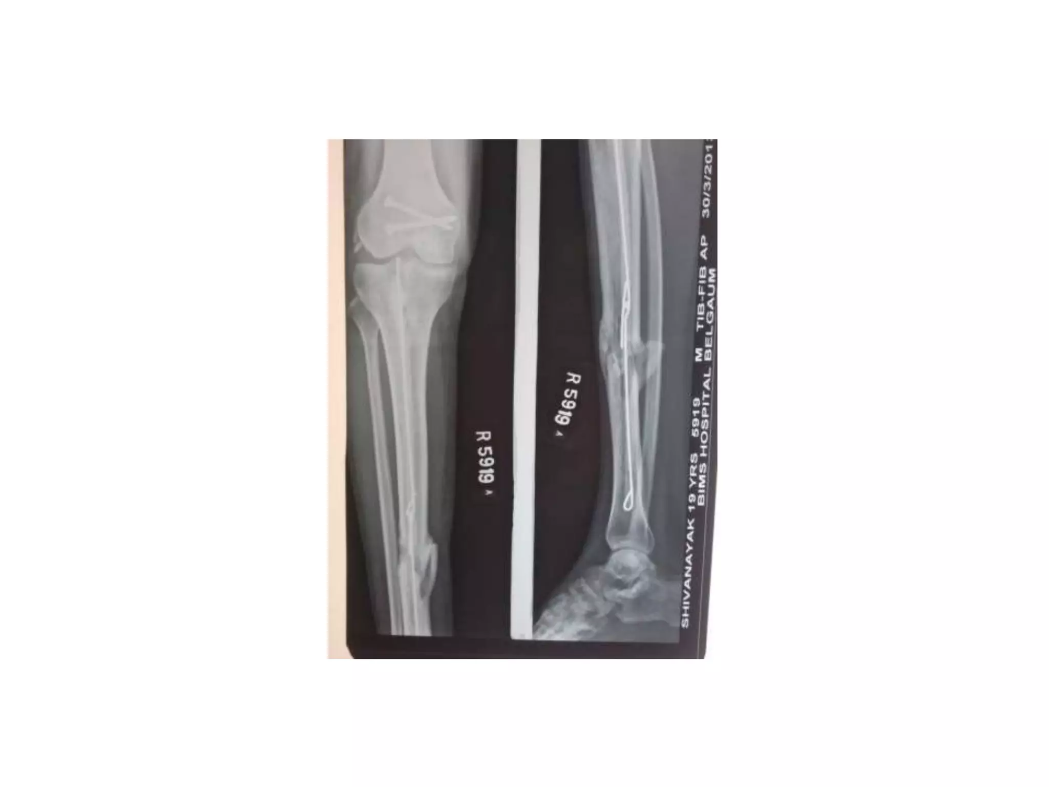 INFECTED FRACTURES, INFIRM PATIENT, INDOMITABLE SURGEON HANDLING NON ...