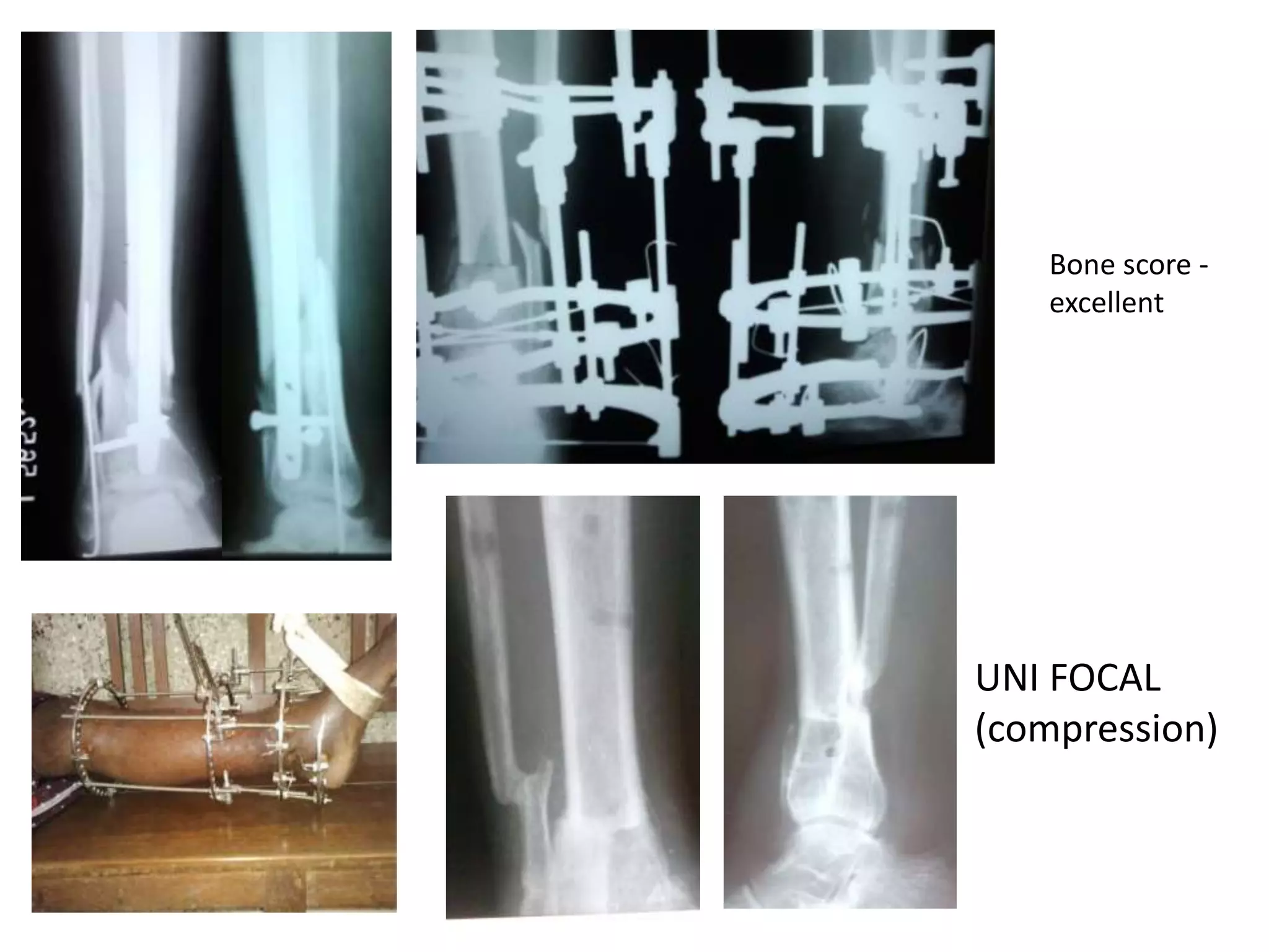 INFECTED FRACTURES, INFIRM PATIENT, INDOMITABLE SURGEON HANDLING NON ...