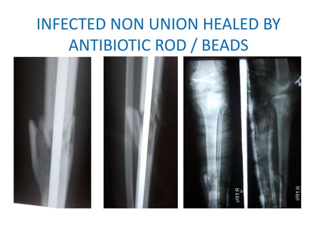 INFECTED FRACTURES, INFIRM PATIENT, INDOMITABLE SURGEON HANDLING NON ...