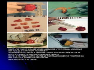 Handling of radical prostatectomy specimens | PPT