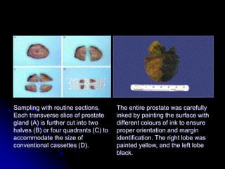 Handling of radical prostatectomy specimens | PPT