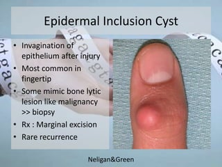 Hand mass: General basic | PPT