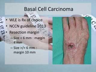 Hand mass: General basic | PPT