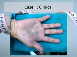 Hand mass: General basic | PPT