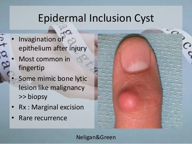 Hand mass: General basic