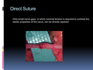 Hand nerve repair | PPTX