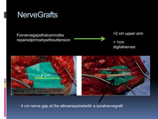Hand nerve repair | PPTX