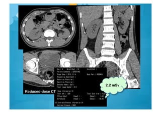 Stone protocol CT: Why, How and Pitfalls | PDF