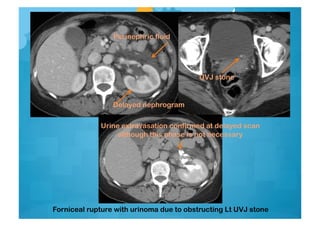 Stone protocol CT: Why, How and Pitfalls | PPT