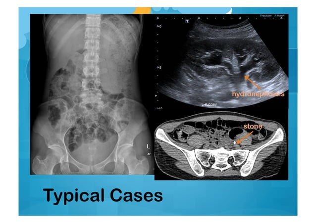 Stone protocol CT: Why, How and Pitfalls | PPT | Free Download